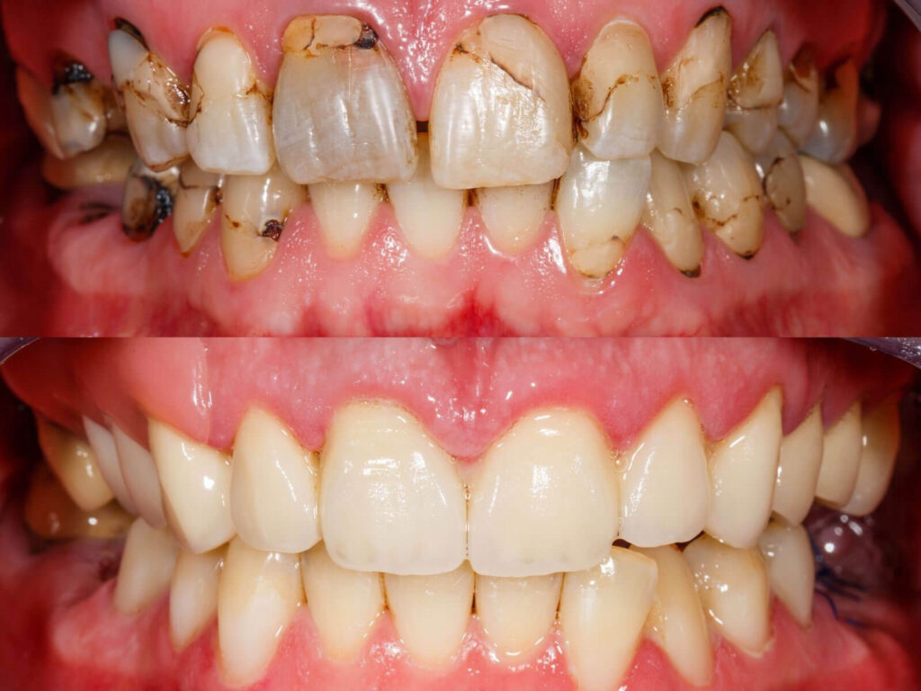 How Smoking Affects Your Teeth