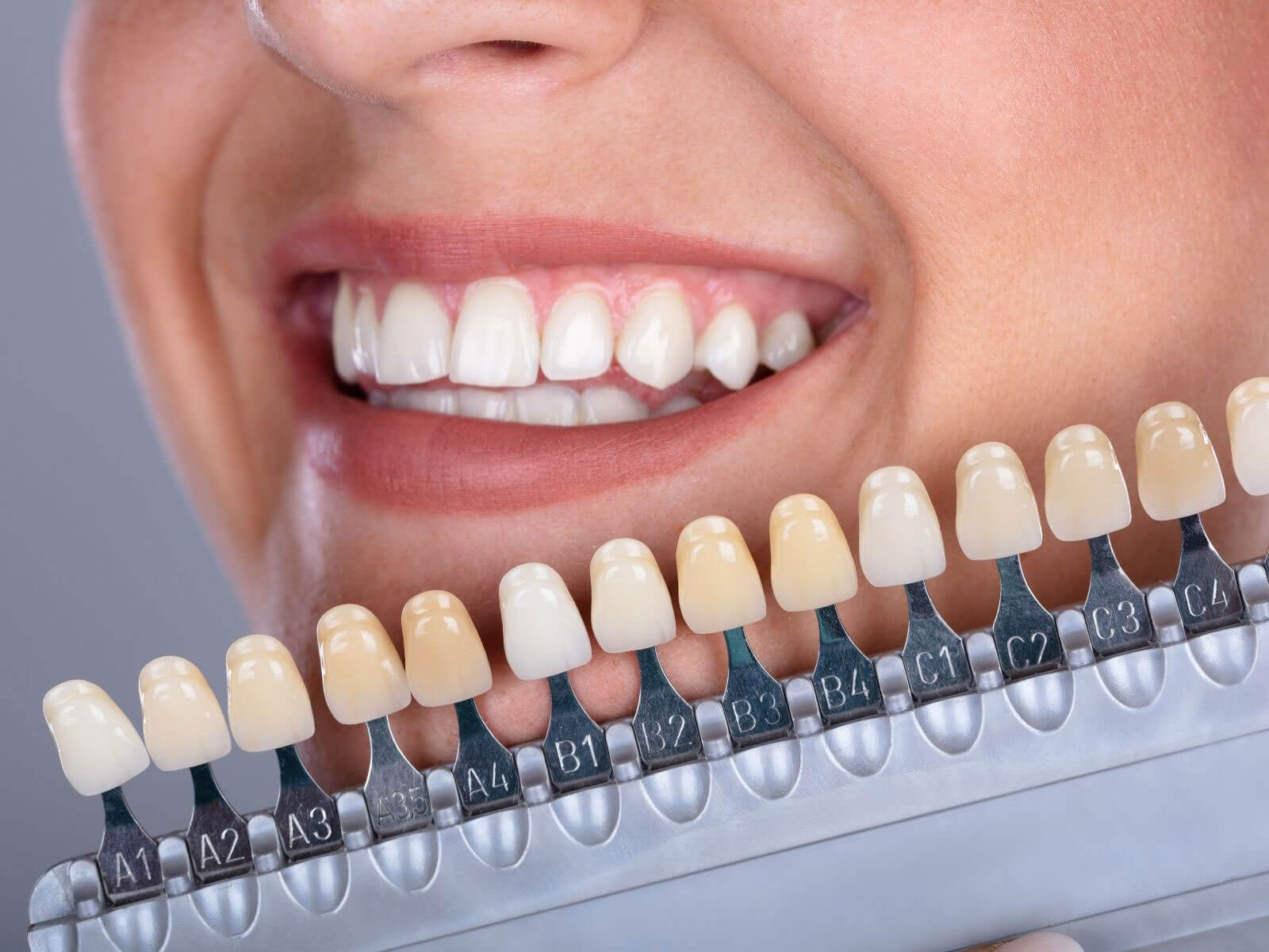 The Benefits of Professional Teeth Whitening