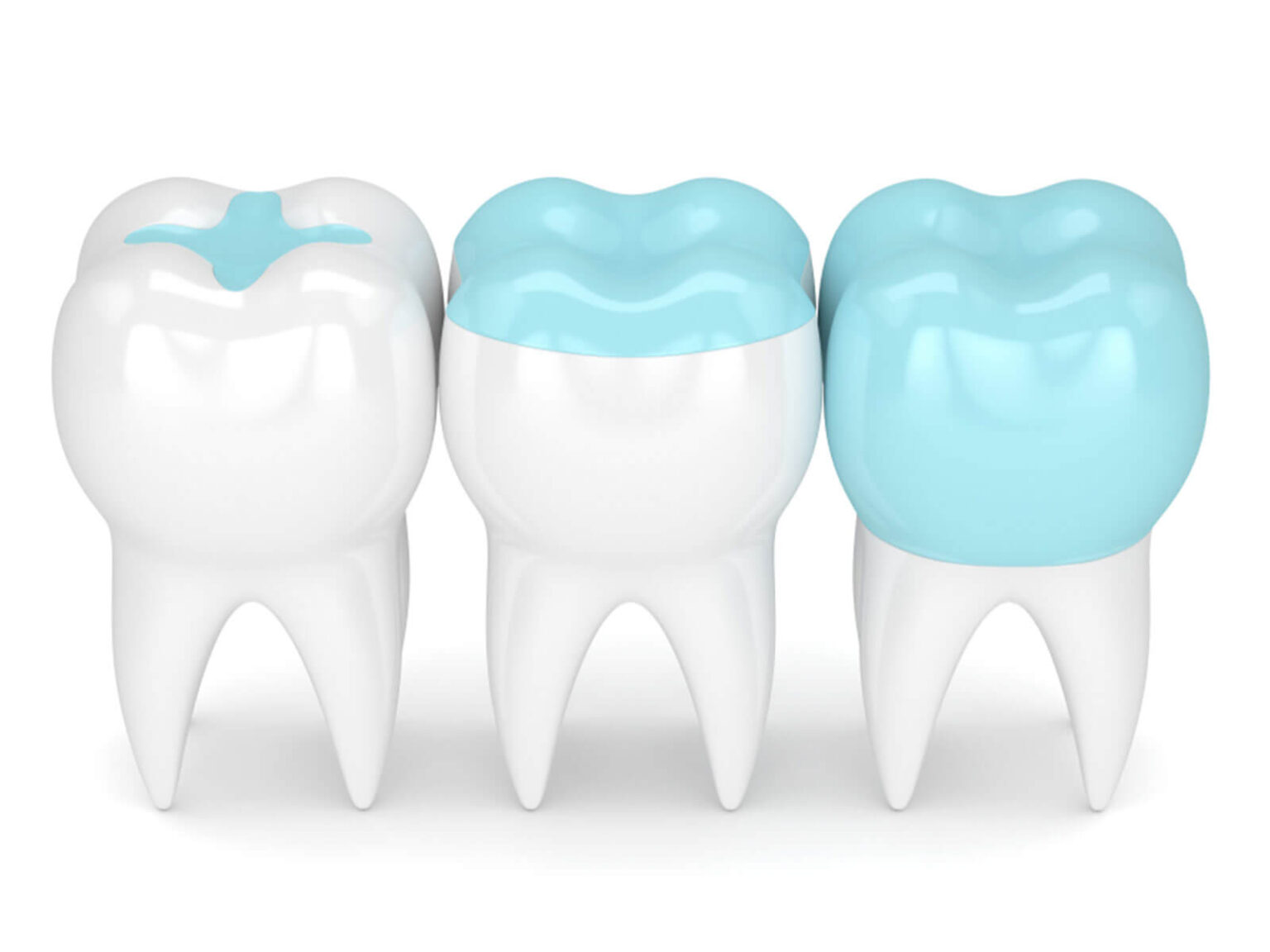 Dental Inlay vs Onlay: What’s the Difference