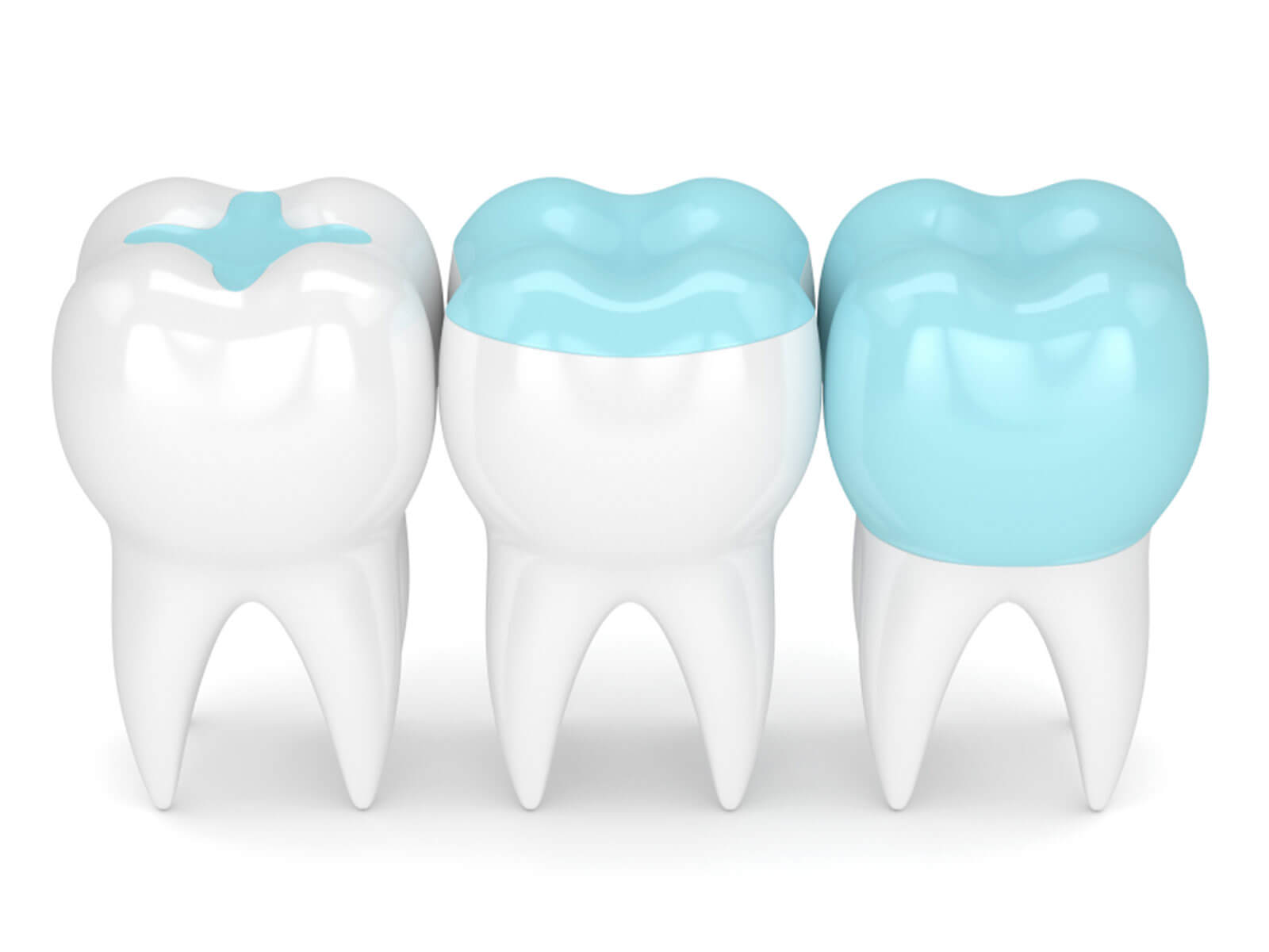 Dental Inlay vs Onlay: What’s the Difference